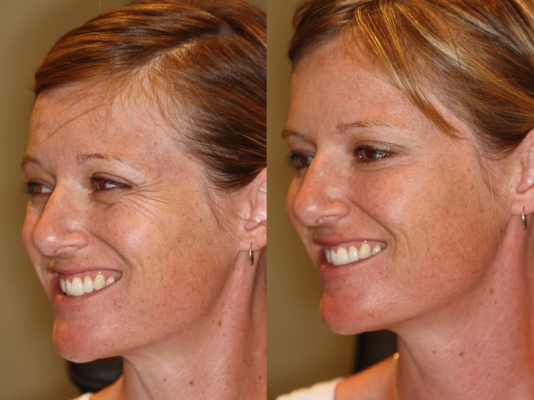 Botox in Rhode Island - Botox