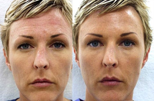 Botox in Rhode Island - Botox